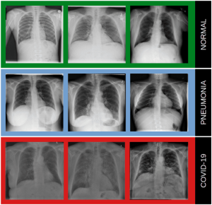 Improved Chest Pre-Diagnosis X-Ray launched by MinoHealth - GhScientific